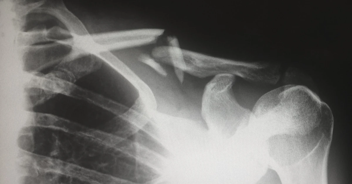 Axillary View Shoulder – What Is It And Why Is It Important?