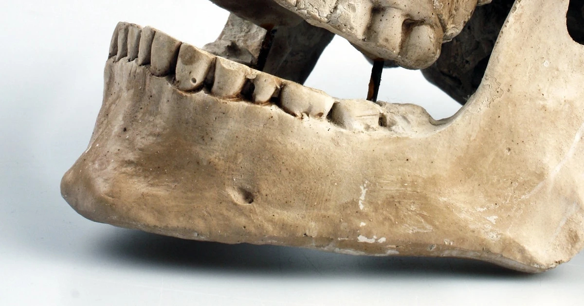 Mental Foramen – Why It Matters