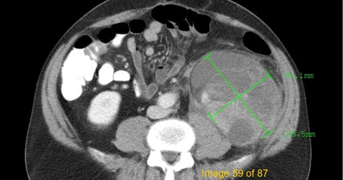 Retroperitoneal Liposarcoma - Definition, Diagnosis, And Treatment