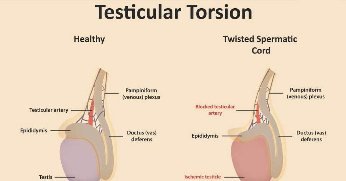 Torsion Of The Testis - Reaction After Hydrocelectomy