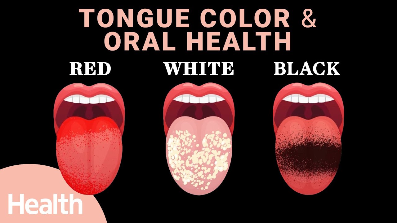 Tongue Signs Of Health Problems – How To Interpret Them For Good Diagnosis