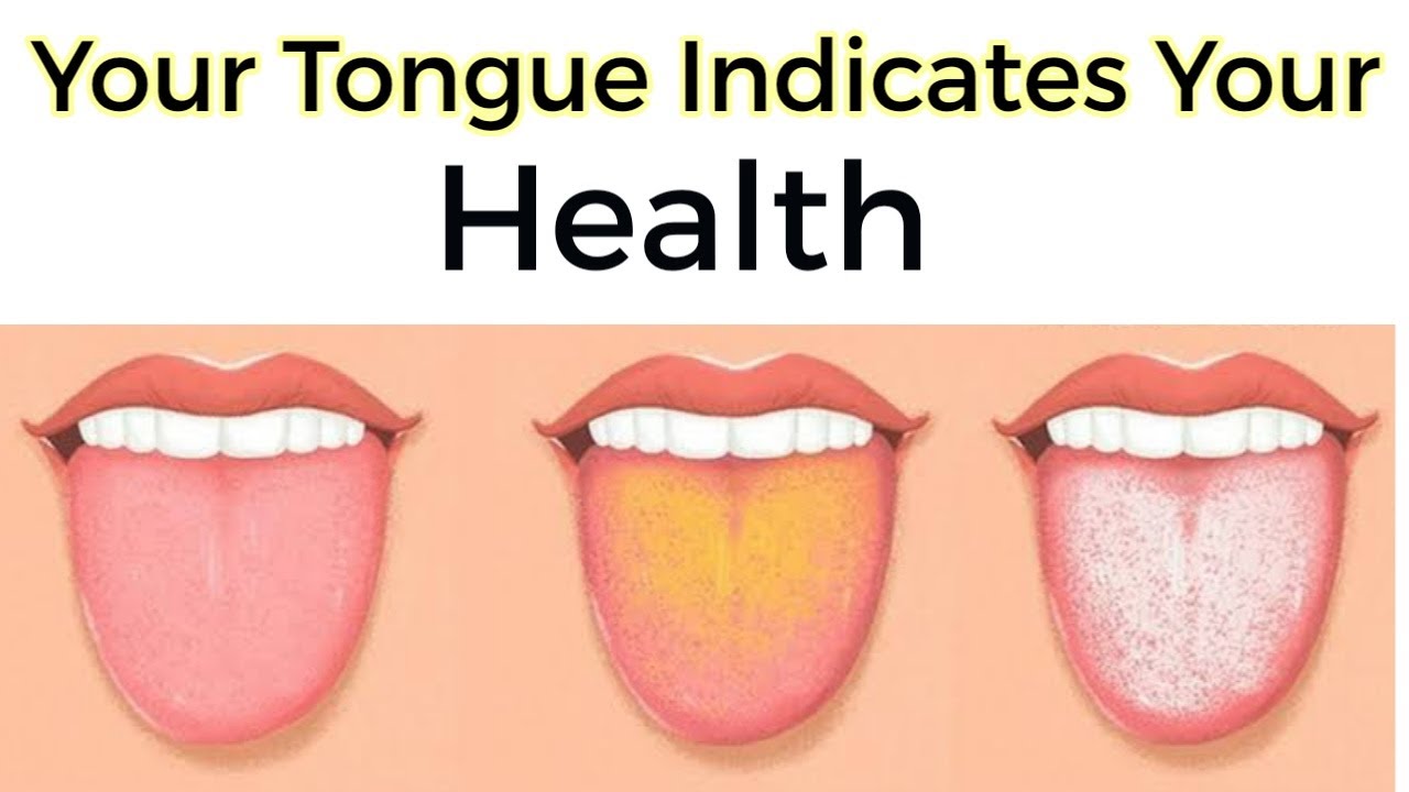 Tongue Signs Of Health Problems – How To Interpret Them For Good Diagnosis
