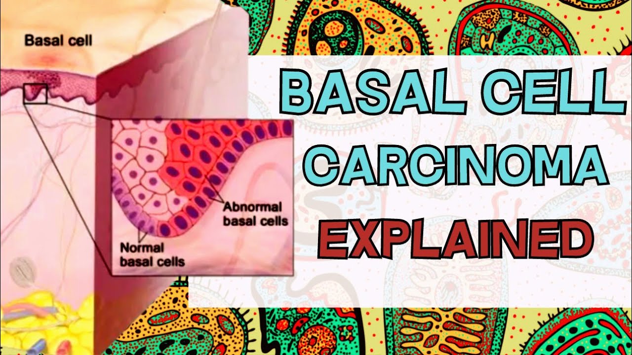 Frankincense Oil For Basal Cell Carcinoma – Facts And Management