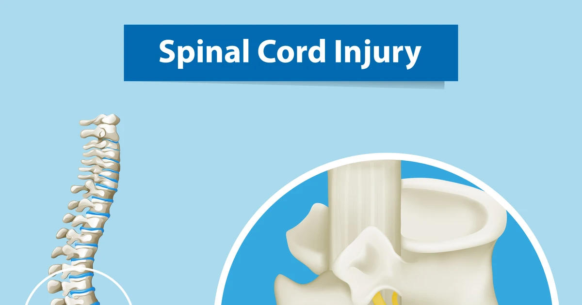 Autonomic Dysreflexia Spinal Cord Injury - What Is It? Causes, Symptoms ...