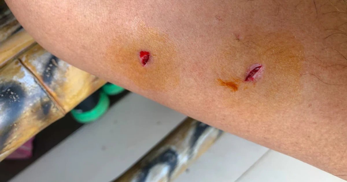 Dog Bite Wounds And Injuries - How To Manage And Save Them From Infection