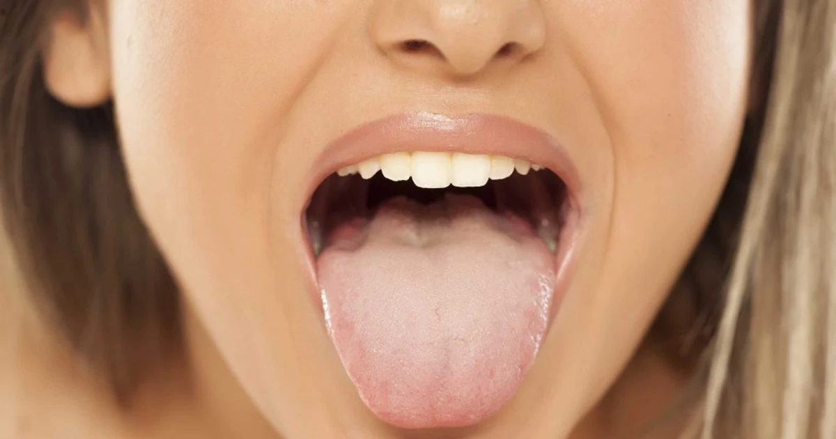 Skin Tag Under The Tongue - What It Is And How It Can Be Removed
