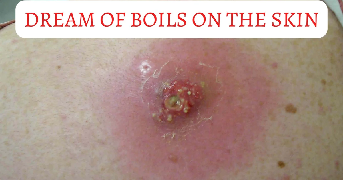 Dream Of Boils On The Skin - It Denotes The State Of Your Life