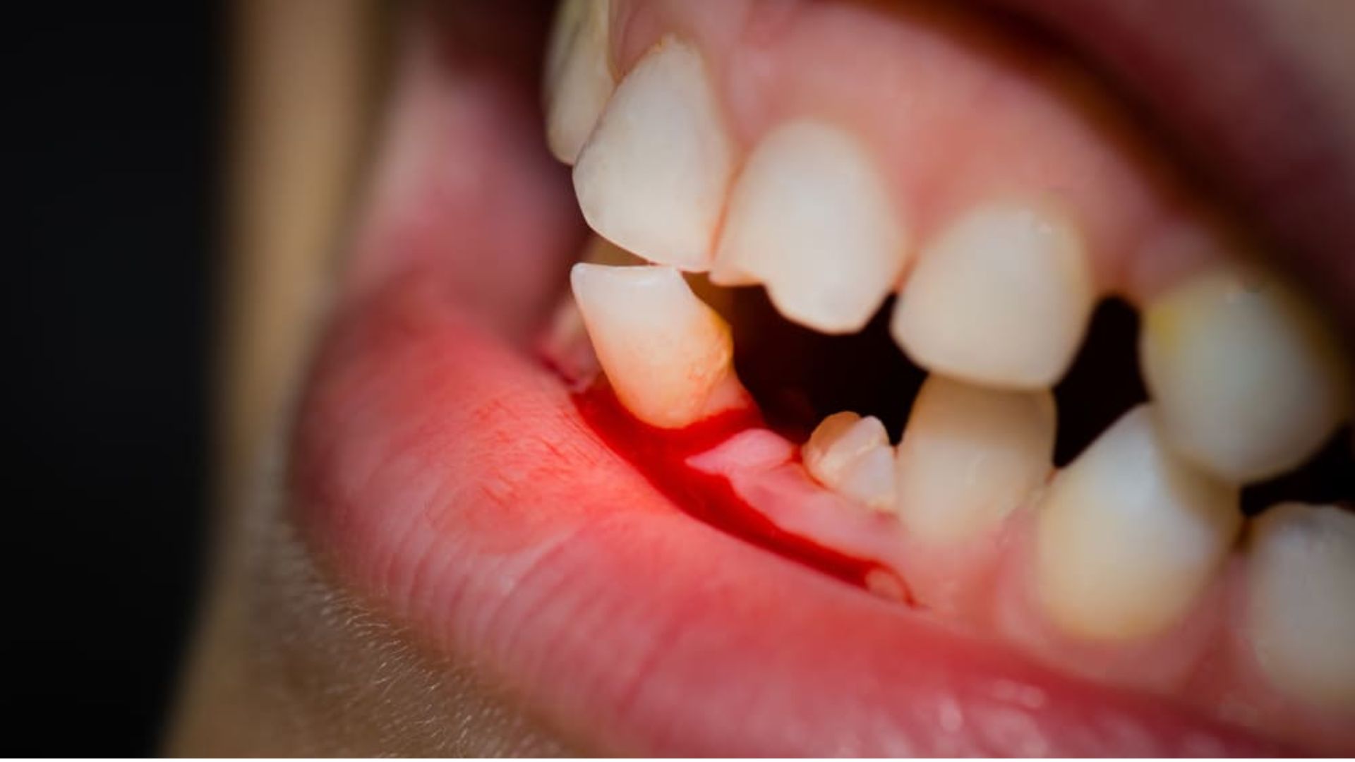 What Does It Mean To Dream About Teeth Falling Out?
