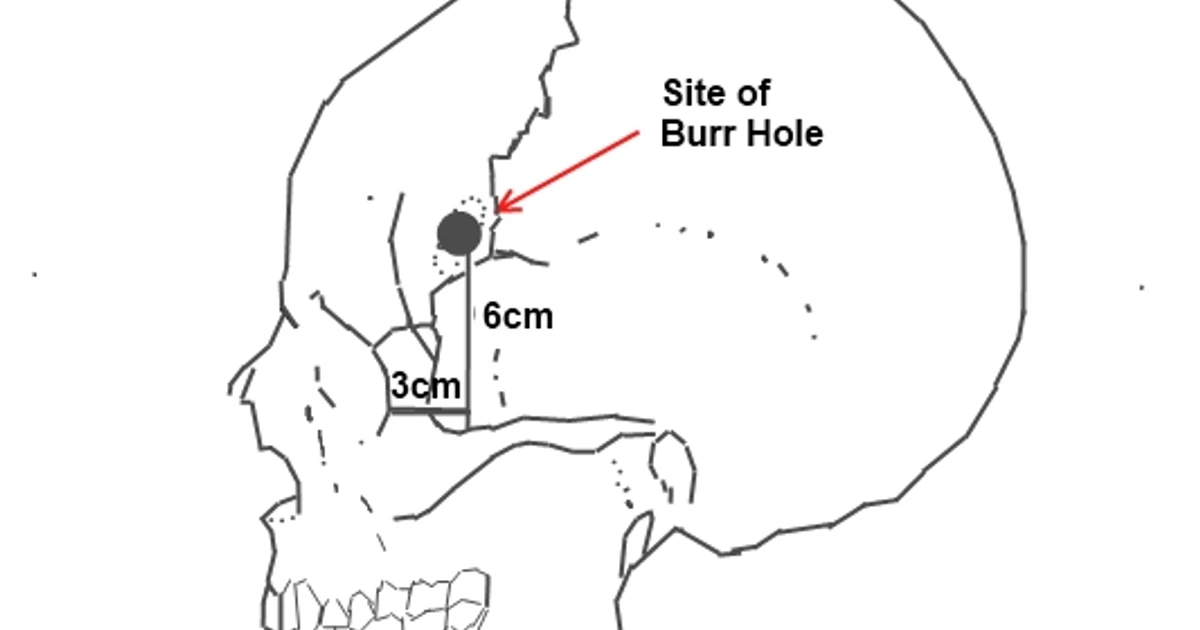 Lobotomy - History, Facts, Procedures & Side Effects