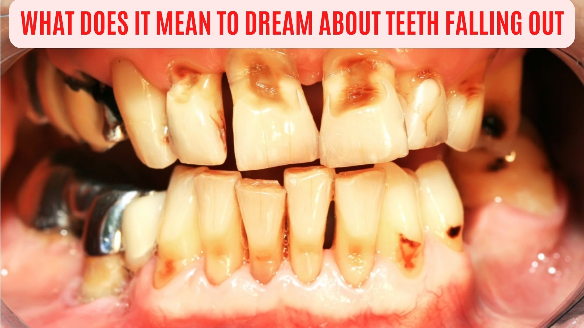 What Does It Mean To Dream About Teeth Falling Out?