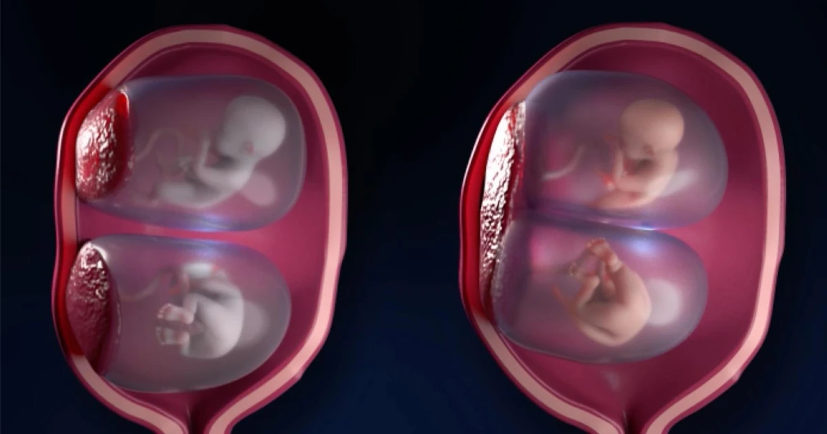 Polyhydramnios In Dichorionic Diamniotic Twins - Causes, Symptoms, And ...