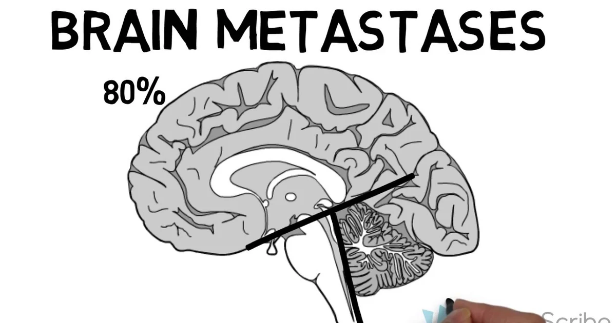 Metastatic Brain Tumours - The Molecular Genomics To Better Understand It