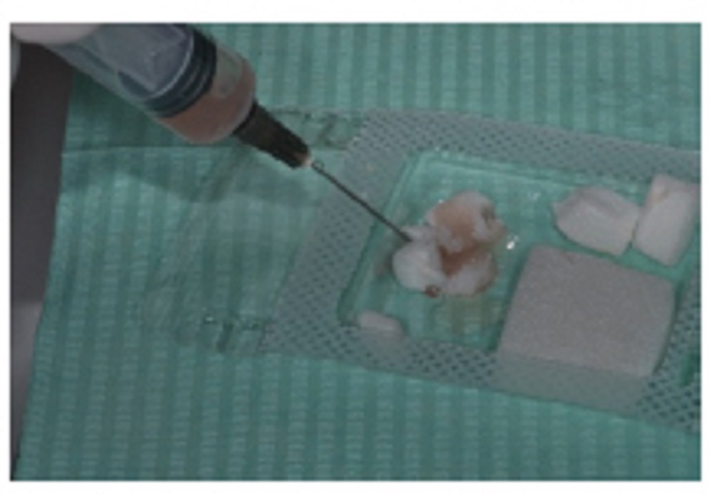 Periodontal Tissue Generation Using Autologous Dental Ligament Micro ...